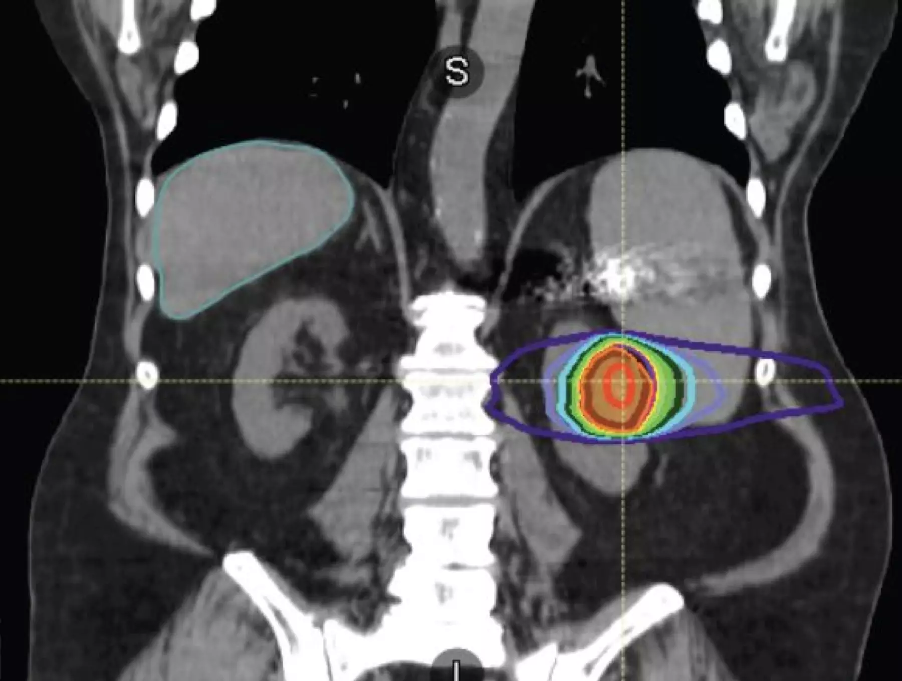 Stereotactic Ablative Radiotherapy | Targeting Cancer AU & NZ