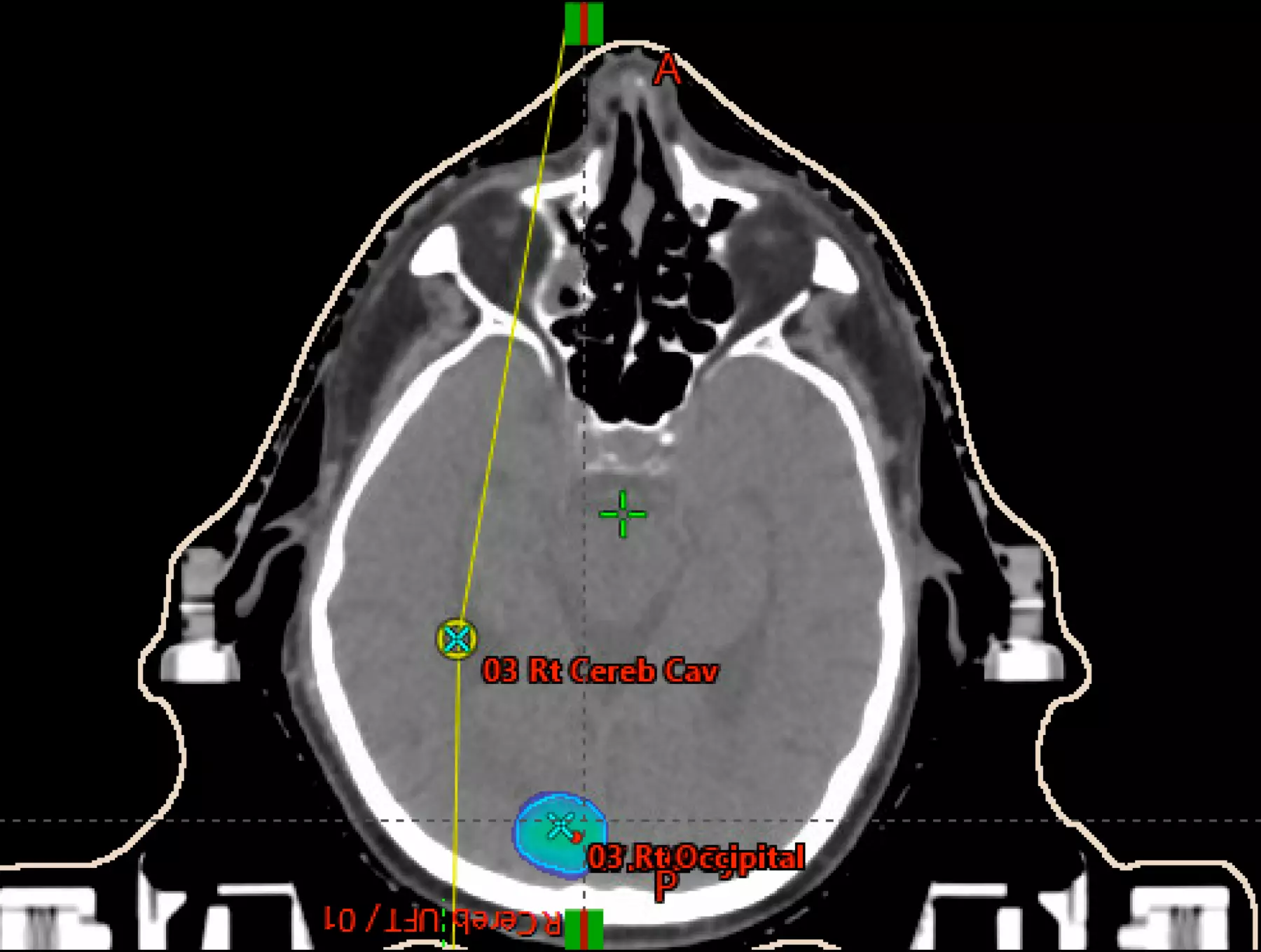 Stereotactic Radiosurgery in AU & NZ | Targeting Cancer